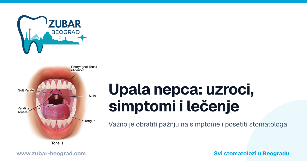 Upala nepca: uzroci, simptomi i lečenje | Zubar Beograd